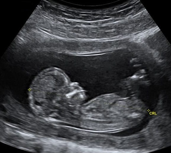 HOME Baby Peek Ultrasound HOME Baby Peek Ultrasound